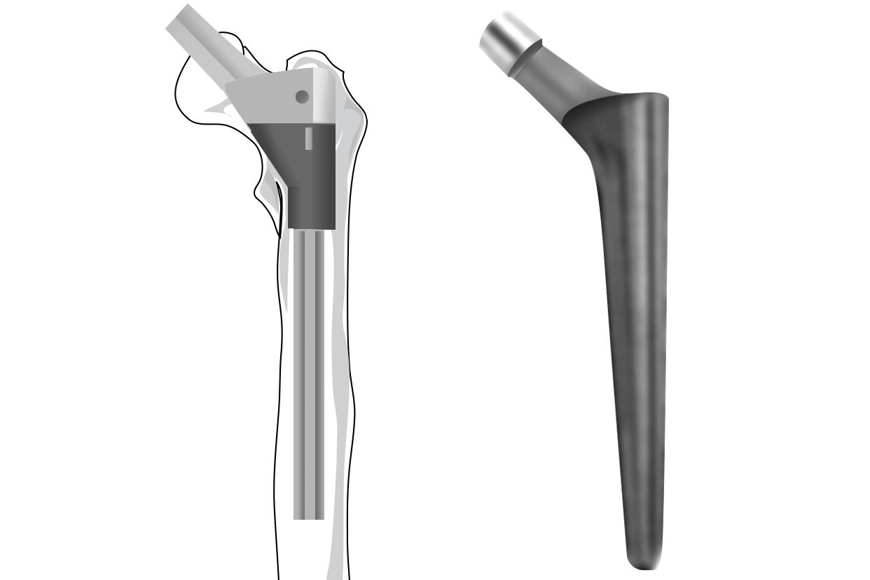 wagnercone股骨柄图片