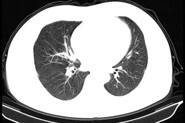 正常人的肺部ct图片 | 百度健康·医学科普