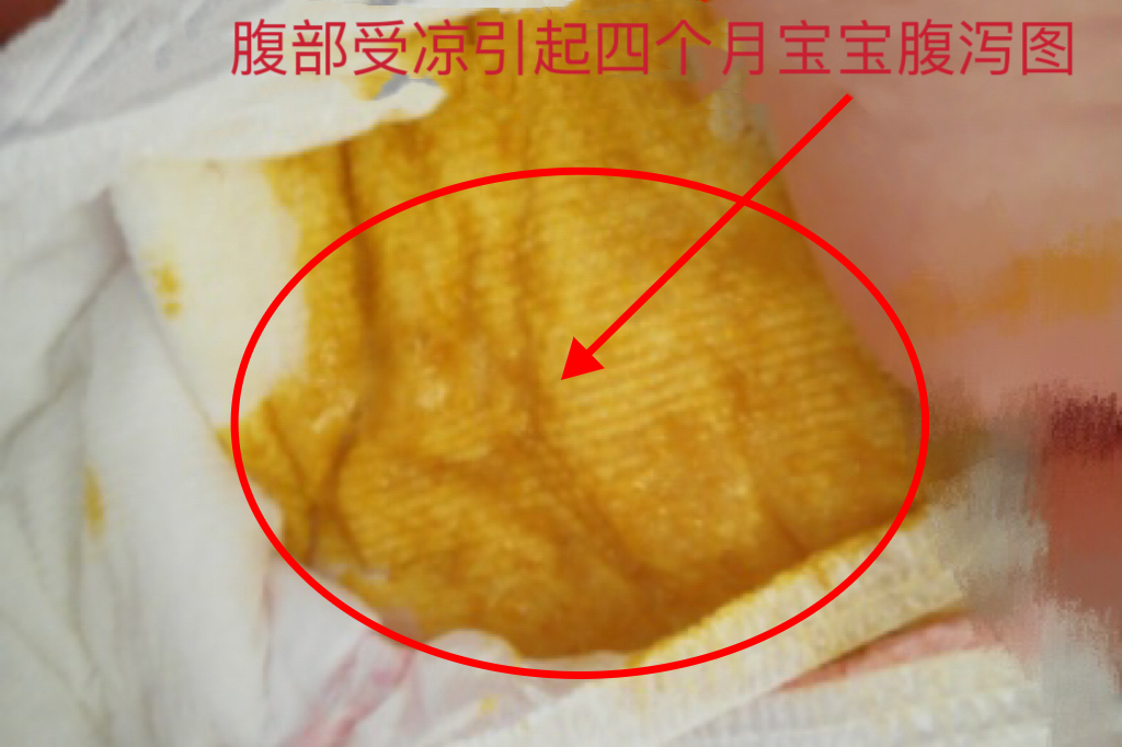 四个月宝宝腹泻症状图片