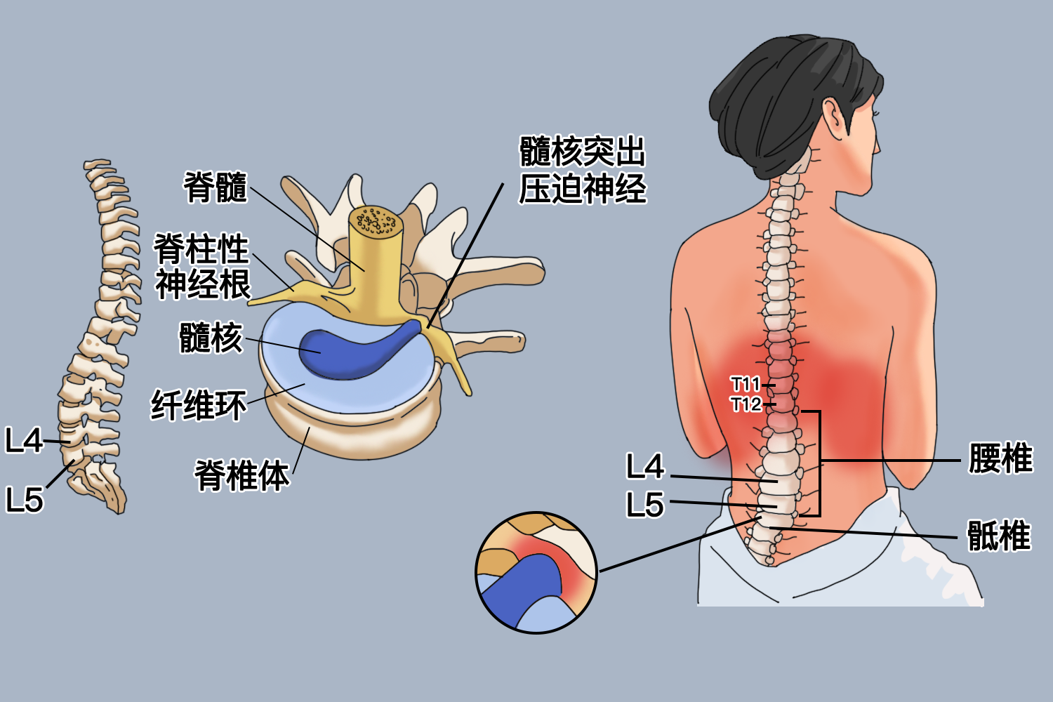 L4一5椎间盘突出图片位置