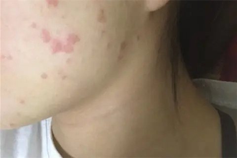 hpv图片症状图片大全 | 百度健康·医学科普