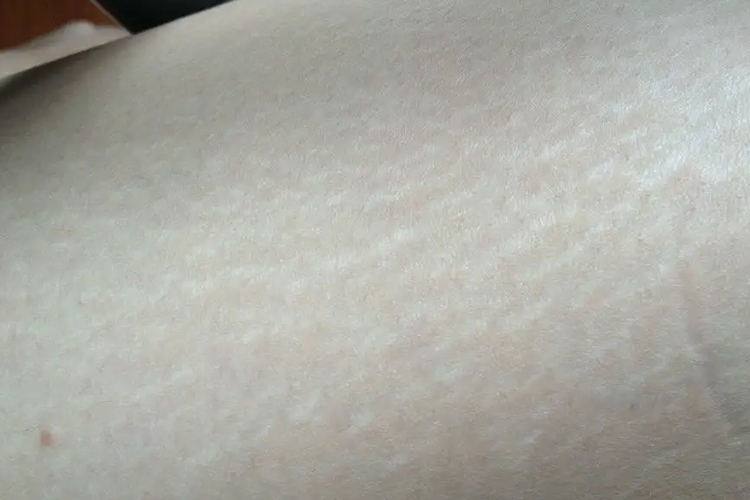 肥胖纹和生长纹区别图
