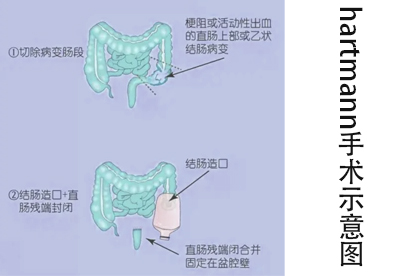hartmann手术示意图