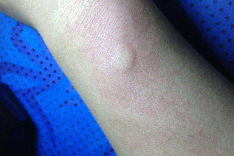 PPD检测正常和不正常图